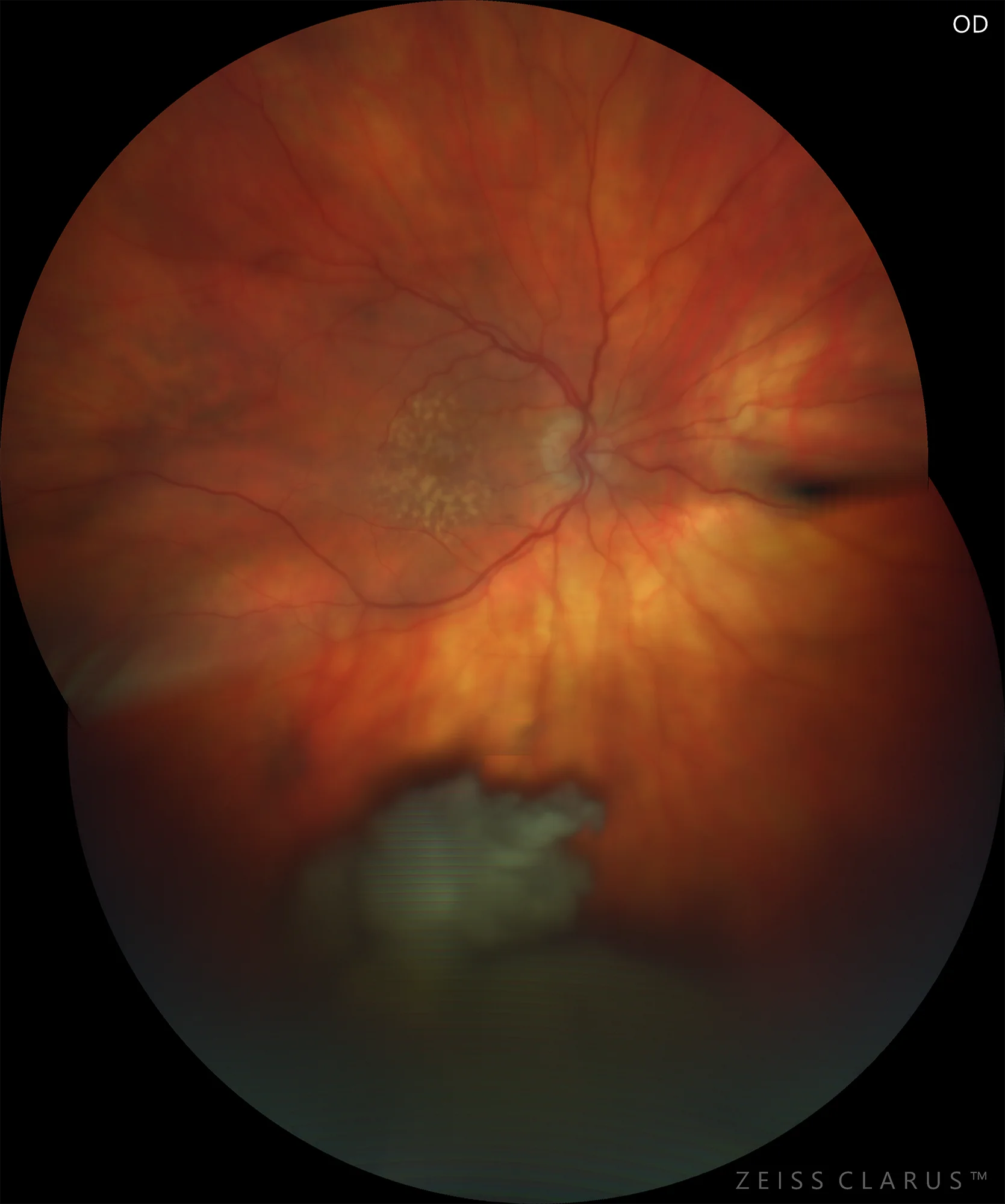 Luxación de fragmentos de cristalino en el vítreo - Retina Club ...