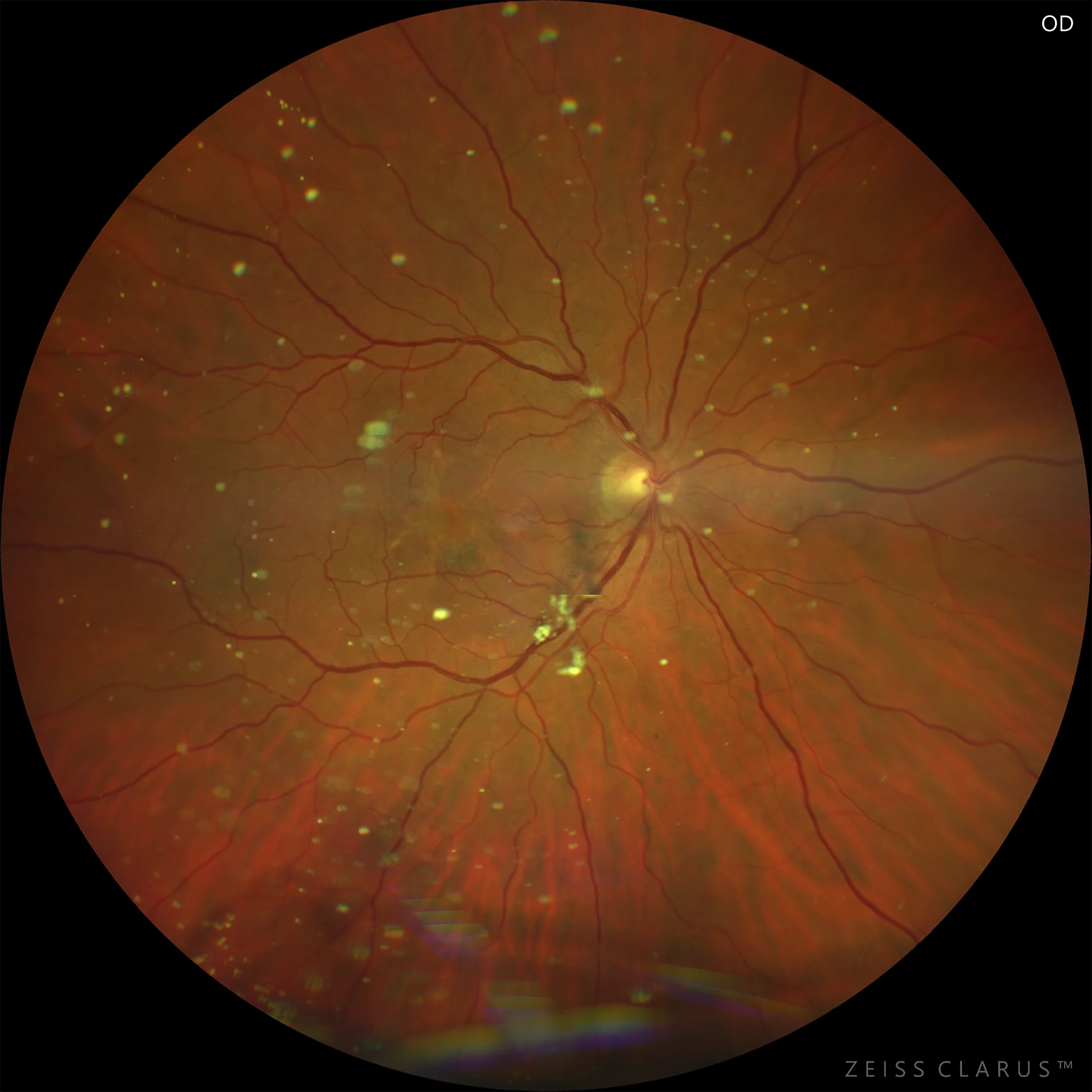 Distrofia macular en alas de mariposa - Retina Club : Retina Club