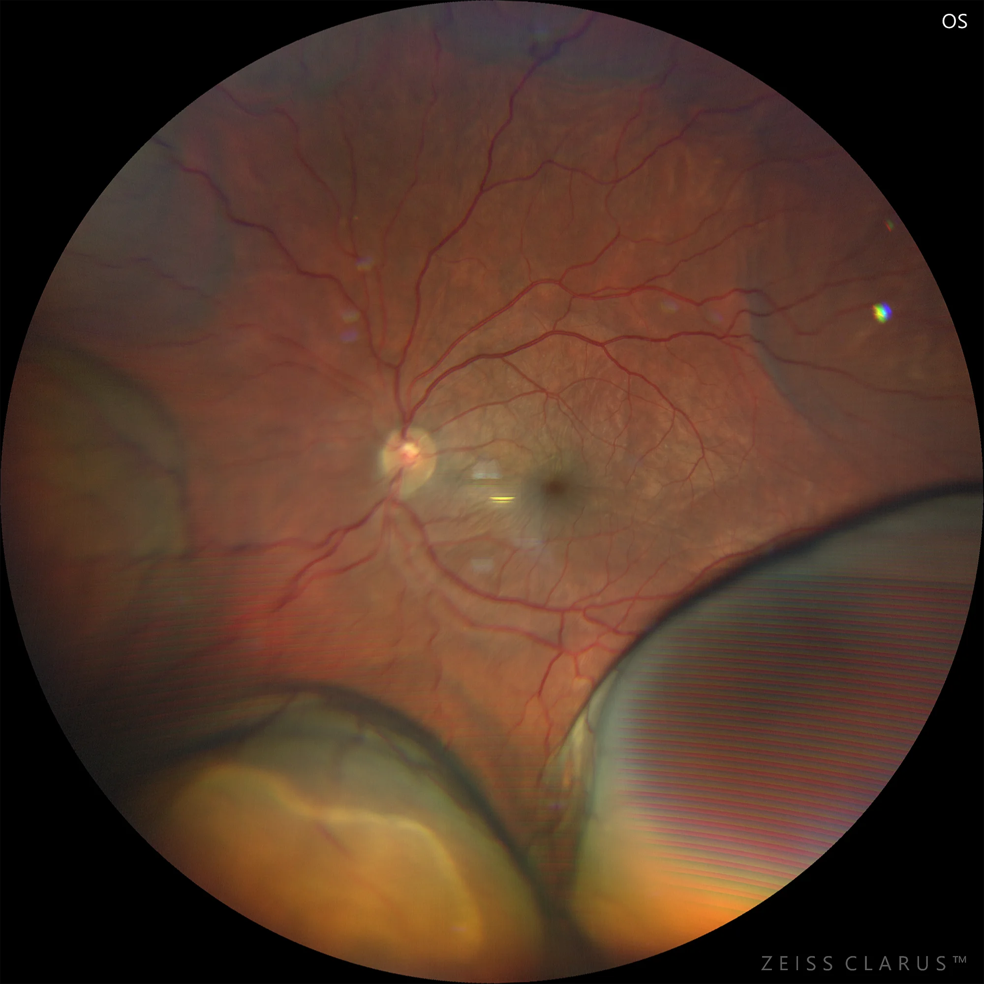 Desprendimientos coroideos postquirúrgicos - Retina Club : Retina Club