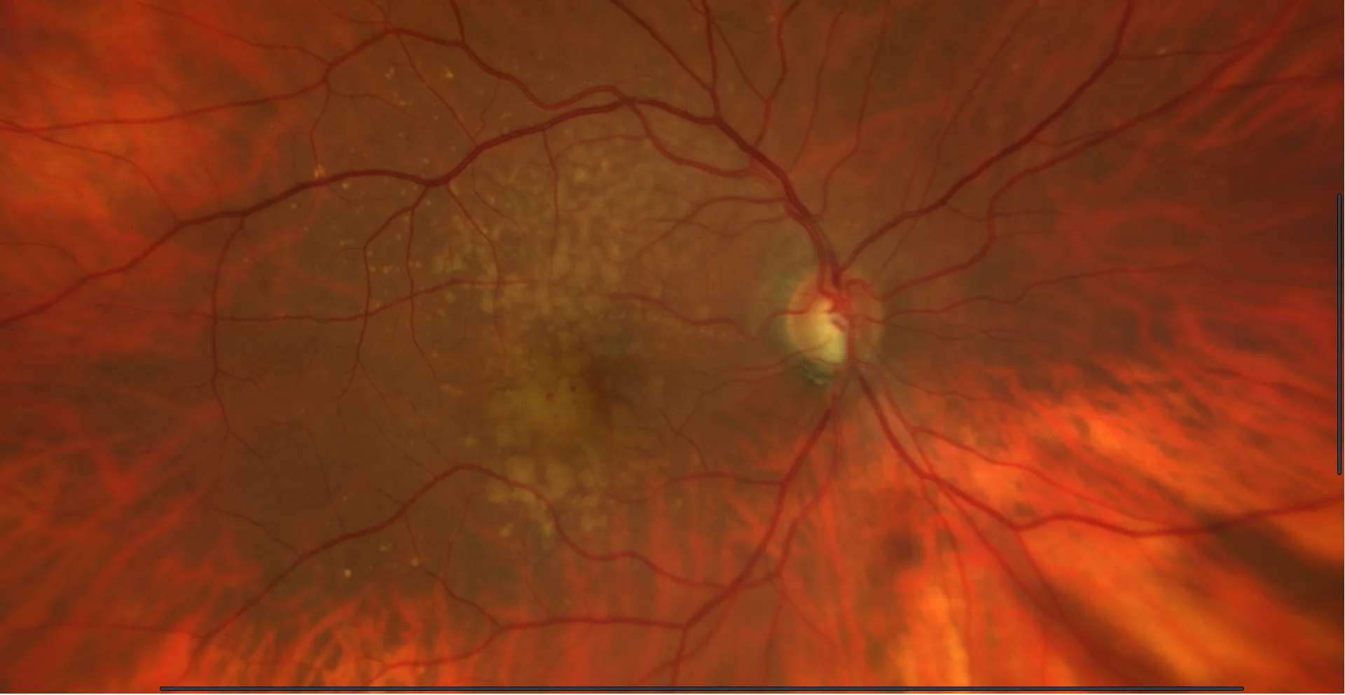 Membrana neovascular tipo 3 - Retina Club : Retina Club
