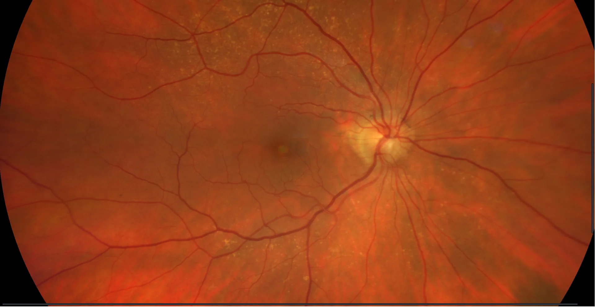 Adult-Onset Foveomacular Vitelliform Dystrophy - Retina Club : Retina Club
