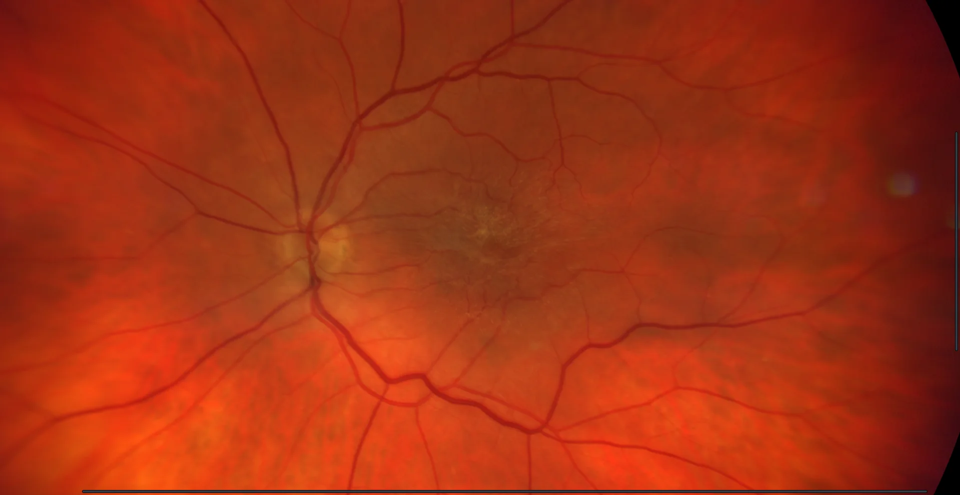 Membrana epirretiniana (MER) - Retina Club : Retina Club
