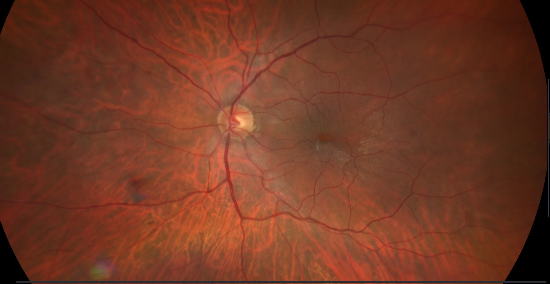 Epiretinal Membrane (ERM) - Retina Club : Retina Club