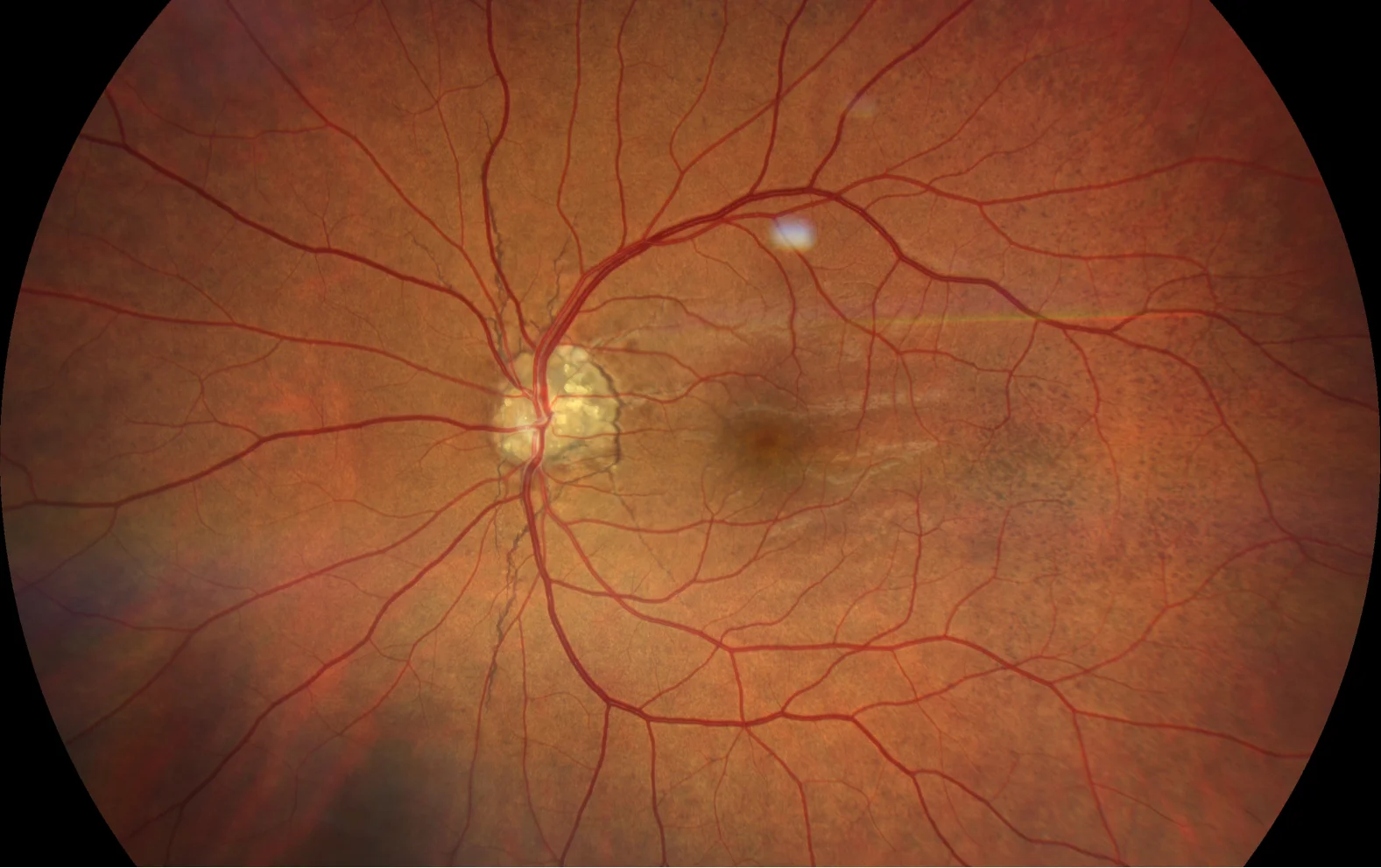 Drusas de papila y estrías angioides - Retina Club : Retina Club