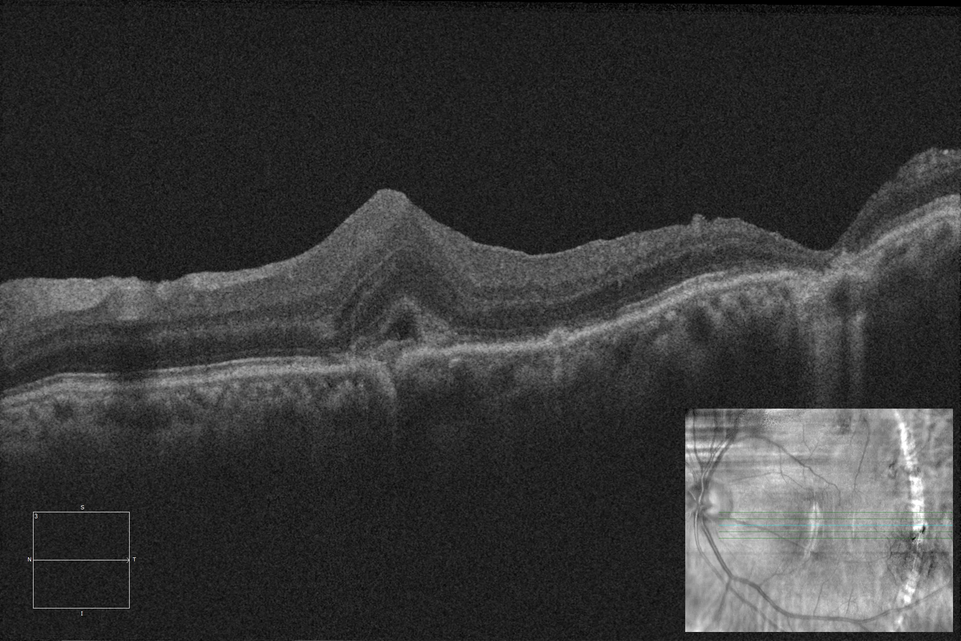 choroidal rupture