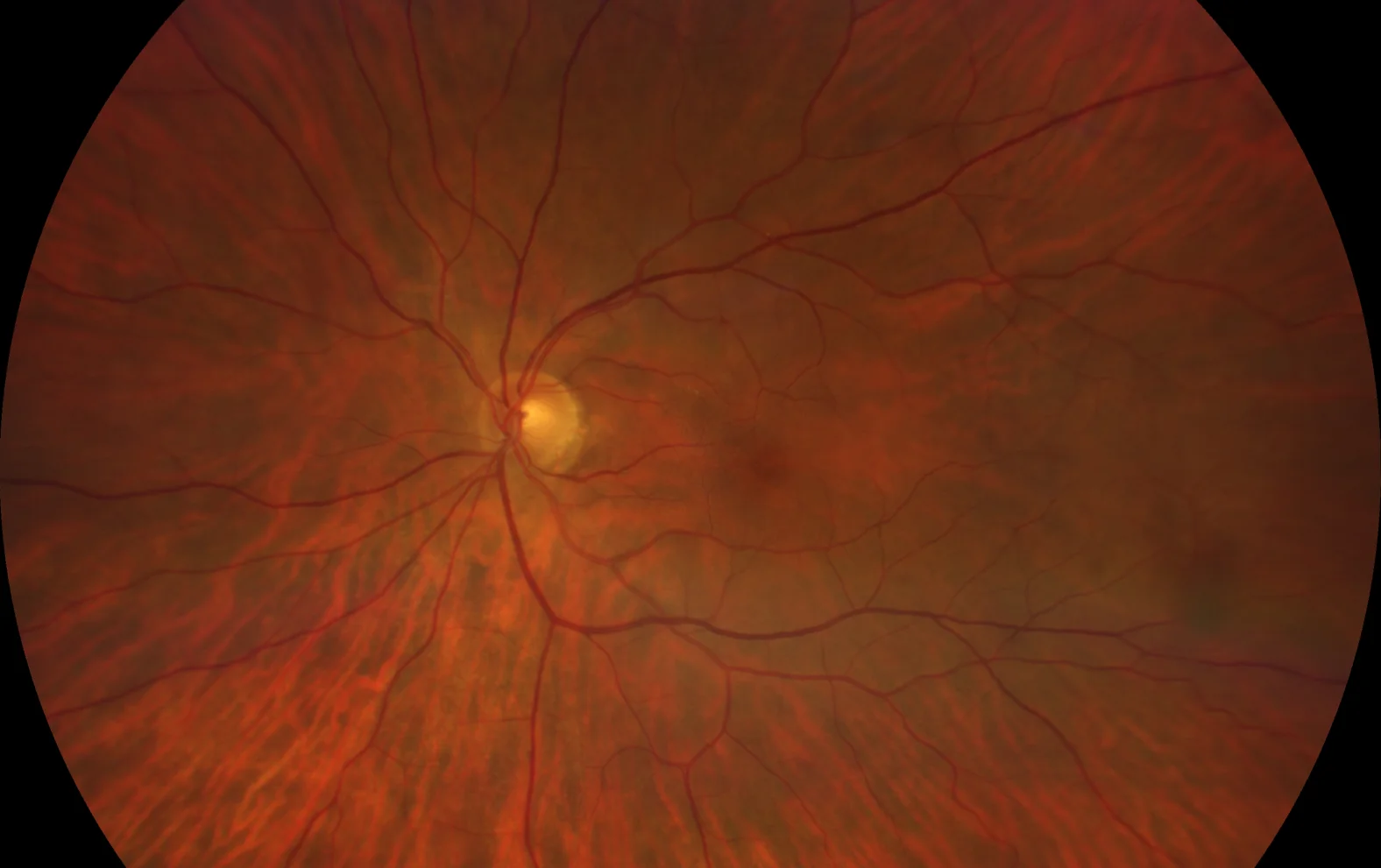 Adhesión vitreomacular - Retina Club : Retina Club